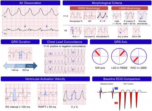 Wide Complex Tachycardia Differentiation - News